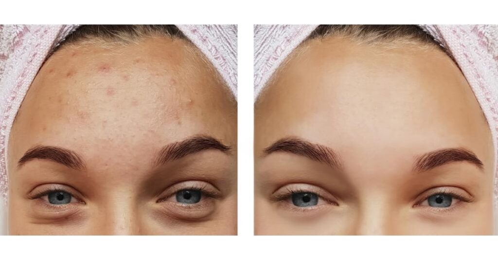 Which Tool is Used to Remove the Imperfections in the Image like Spots ...